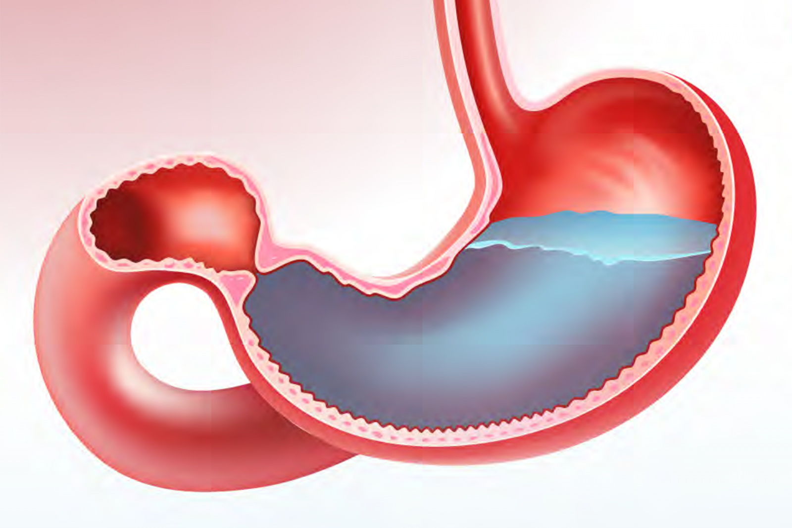 Gastric secretions bag that can measure volume - iNT Mahidol